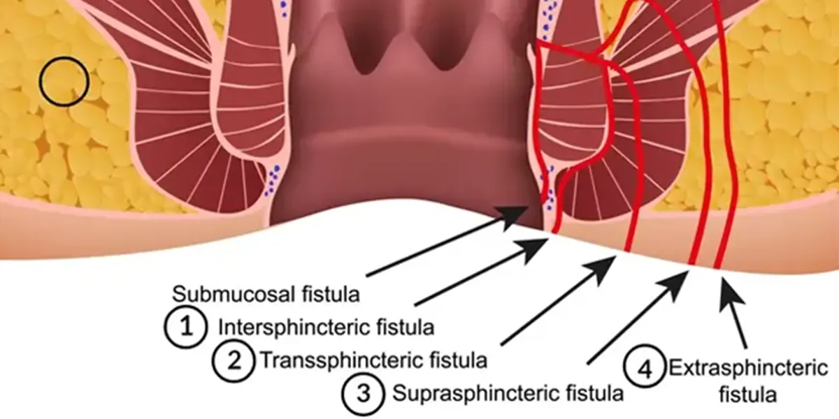 Obat Alami Fistula Ani: Aman dan Cara Pakainya - Lasehatin